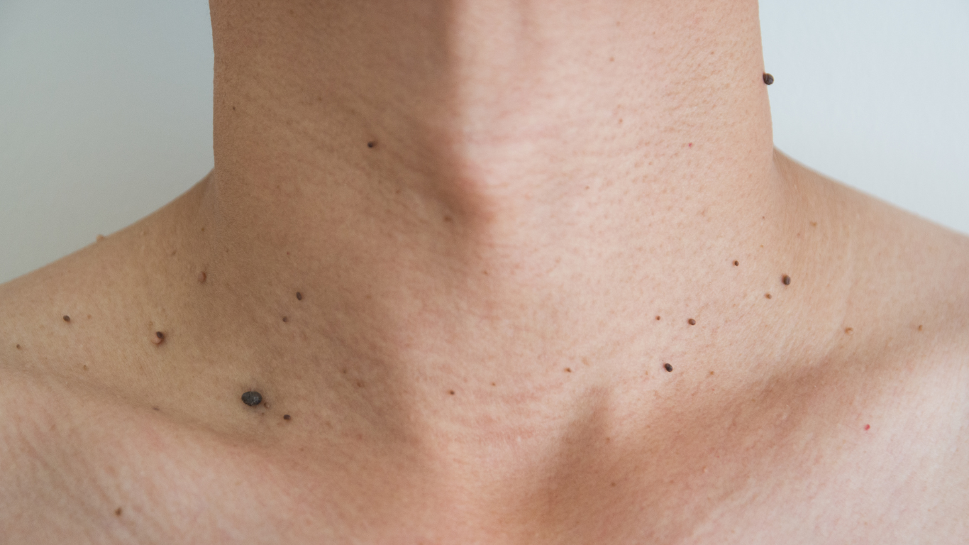 Skin Tags—Causes, Treatments, and Whether You Should Remove Them